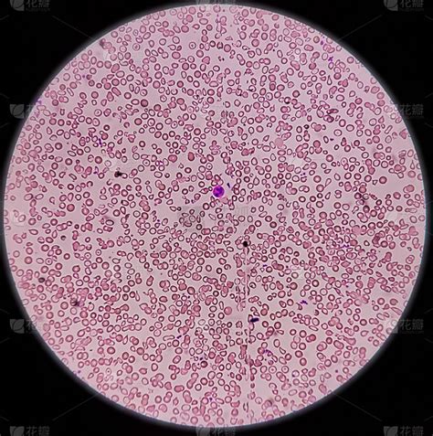 遗传性溶血性贫血。血红蛋白e Hbe病，伴异数细胞增多的低血色症，铅笔细胞，靶细胞，泪滴细胞，偶