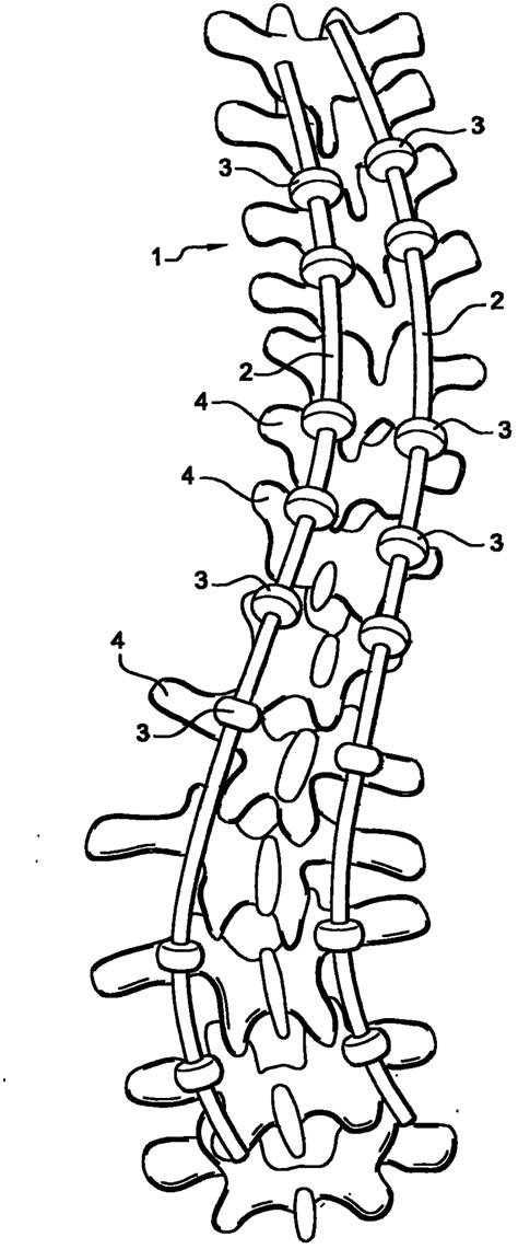 Spinal Osteosynthesis System Eureka Patsnap