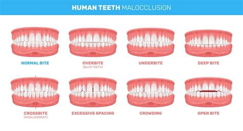 Malocclusion Of Teeth Infographics Free Vector