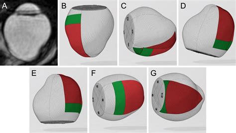 Directions Of The Three Dimensional Vitreous Cavity In Case 1 A The Download Scientific