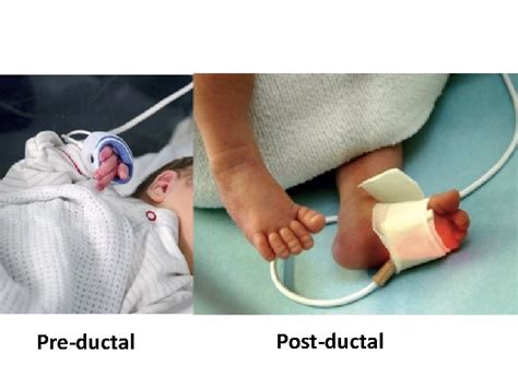 Pulse Oximetry In Newborn Screening At Chris Colon Blog