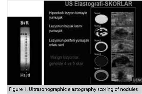 Figure 1 From The Predictive Value Of Elastography In Thyroid Nodules And Its Comparison With
