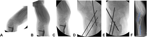 Traumatic Volar Carpal Instability Nondissociative A Case Series