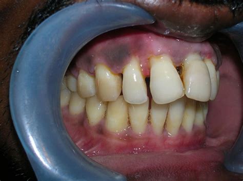 Plasma Cell Gingivitis
