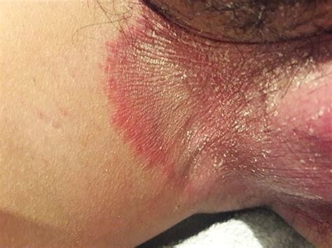 Fungal Infection Inner Thigh