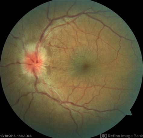 Hypotony Maculopathy Retina Image Bank