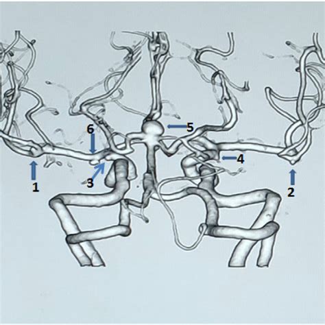 Case 2 Aneurysms With Their Sizes 6 Acom Aneurysm 3 Mm 7 Right