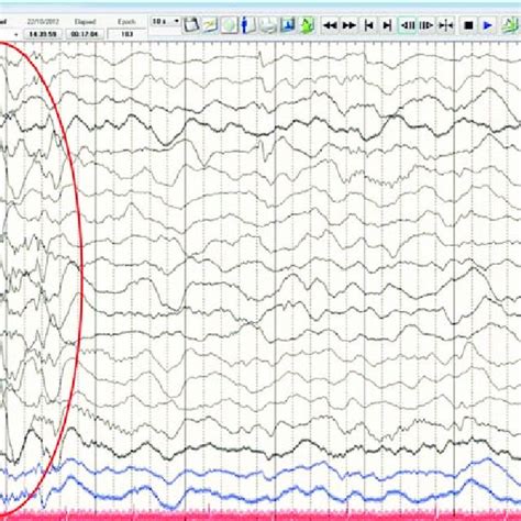 Electroencephalography EEG Showed Generalized Slowing And Multifocal Download Scientific