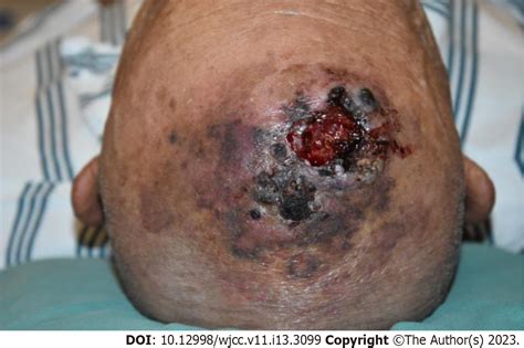 Misdiagnosis Of Scalp Angiosarcoma A Case Report