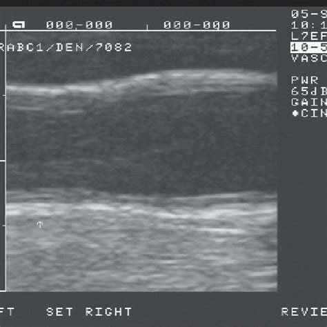 A Image And Off Line Image Analysis Of Intima Media Thickness IMT Of Download Scientific