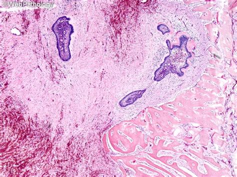 Ameloblastoma Desmoplastic Pattern