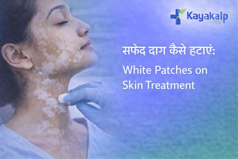 White Patches On Face Home Remedies That Actually Help