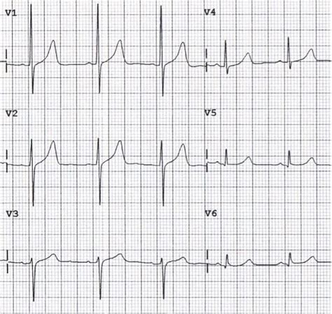 Poor R Wave Progression Prwp • Litfl • Ecg Library Diagnosis