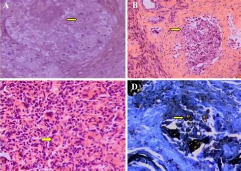 What Is Granulomatous Prostatitis Pathosomes