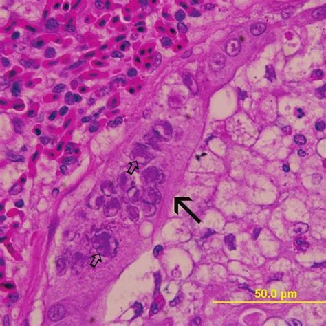 Syncytial Cell Arrow With Intranuclear Inclusion Bodies Open Arrows