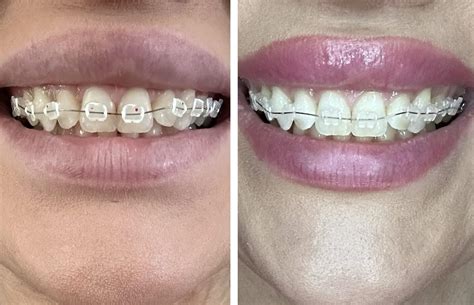 I Got Ceramic Braces Rbraces