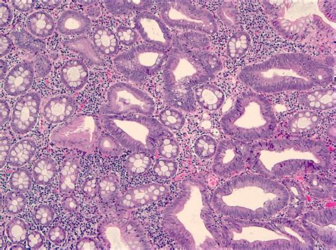 Hyperplastic Polyp Pathology Outlines Clinical Pathology Intestinal