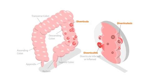 Meckels Diverticulum Symptoms Risks And Treatments Los Angeles Times