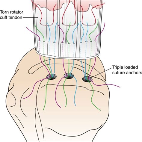 Patte Classification Of Full Thickness Rotator Cuff Tear A Stage 1 Download Scientific