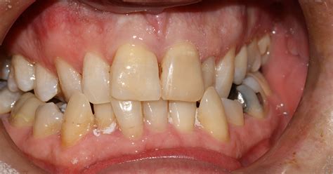 Composite Bonding On A Discoloured Tooth Smile Dental Implants