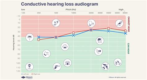 Conductive Hearing Loss The Complete Guide