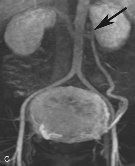 Contrast Enhanced Magnetic Resonance Angiography Radiology Key