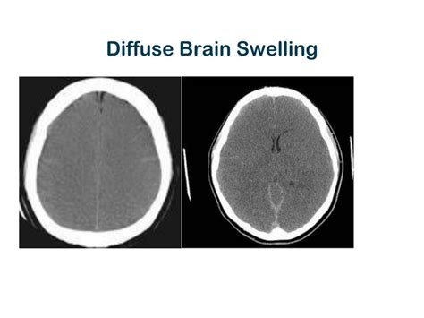 PPT Intracranial Pressure In Traumatic Brain Injury PowerPoint Presentation ID