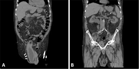 Bladder And Bilateral Ureter Herniation Associated With Bilateral