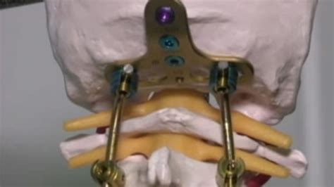 Prótesis Para Columna Vertebral De Colombia Para Latinoamérica
