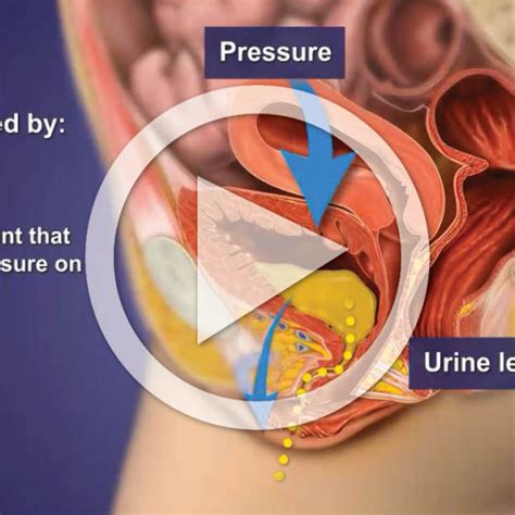 Bladder Prolapse After Sling Surgery