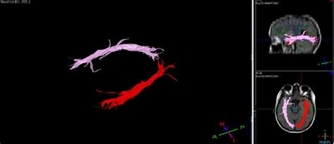 Figure 4 From The Role Of Diffusion Tensor Imaging DTI In Developmental Brain Anomalies In