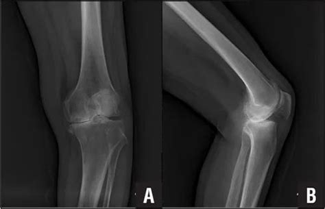 Fibular Osteotomy In Chennai Id 15436838230