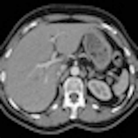 Iterative Reconstruction Shines In Ct Dose Reduction Auntminnieeurope