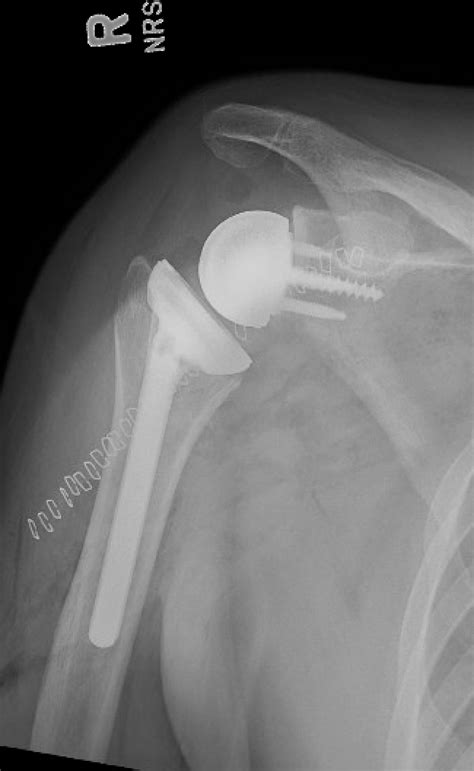 Uw Shoulder And Elbow Academy Acromial Stress Fracture After Reverse Total Shoulder Does