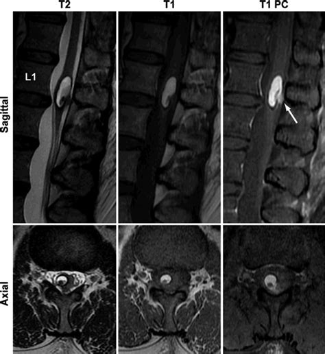 Case Report Conus Medullaris Syndrome From Spinal