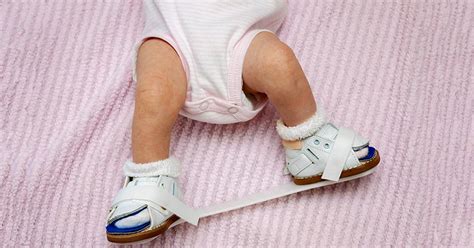 The Ponseti Method For Clubfoot Correction