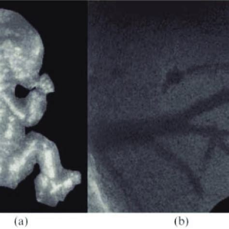 PDF A Survey On D Ultrasound Reconstruction Techniques