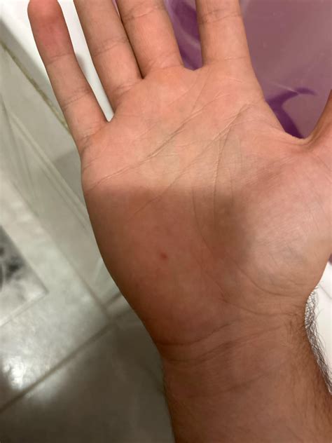 Secondary Syphilis R Syphilis