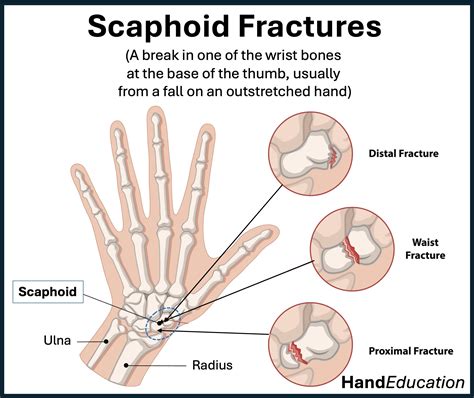 Scaphoid Fractures Hand Education