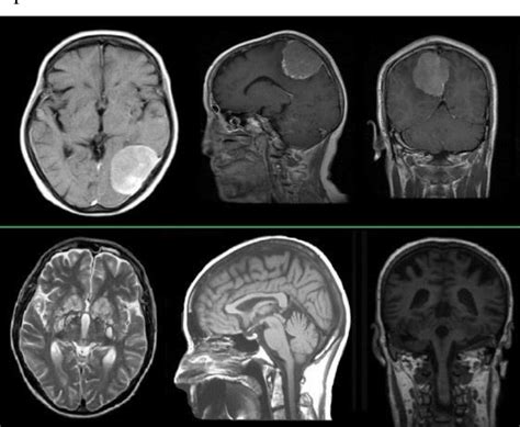 neural gas network image features and segmentation for brain tumor