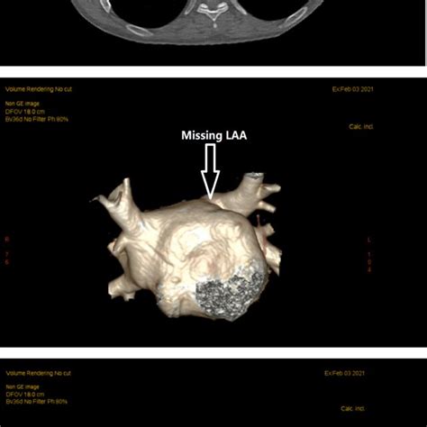 Computed Tomography Of Pulmonary Veins Showed No Left Atrial Appendage Download Scientific Diagram