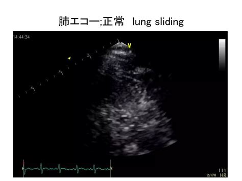 Lung Echo For Slideshare Ppt