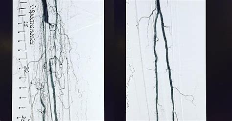 Tibioperoneal Trunk Posterior Tibial And Peroneal Artery Reconstruction For Cli R Cathlablounge