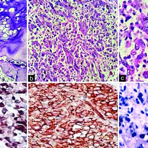 Pdf Proximal Epithelioid Sarcomatous Dedifferentiation In Secondary Chondrosarcoma In A Known
