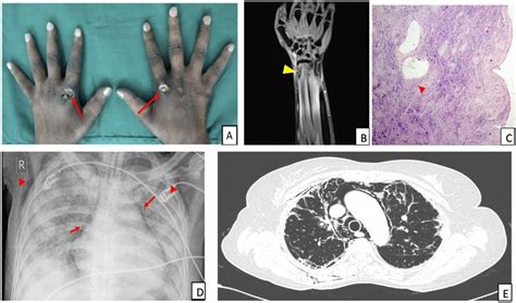 Clinical And Radiological Features In Anti Mda 5 Associated