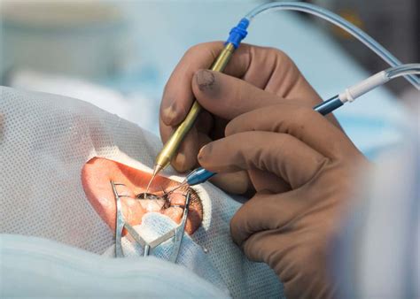 Aphakia Causes And Treatment