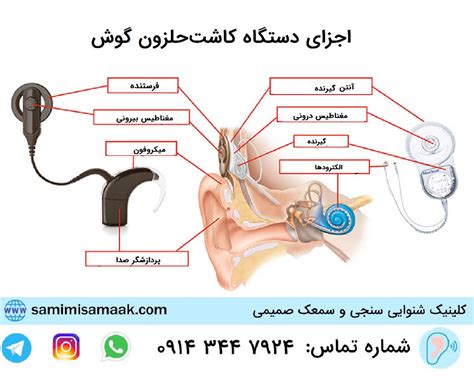 کاشت‌ حلزون بیماران کاندید و هزینه‌های عمل