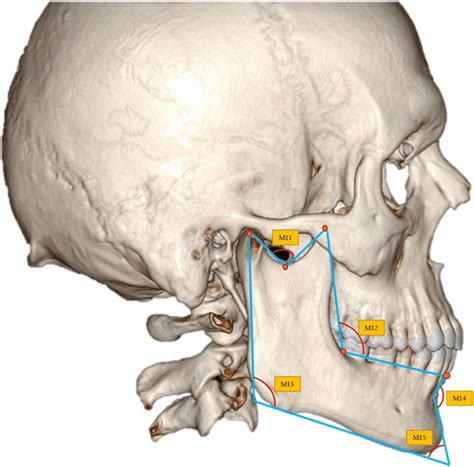 Angular Parameters On Mandible Right Side View M11 Angle Of Download Scientific Diagram