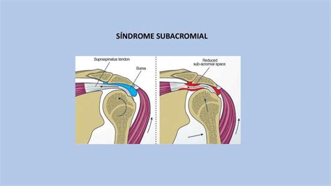 Sindrome Subacromial Bmgfisioterapia Apuntes Y Demás Udocz