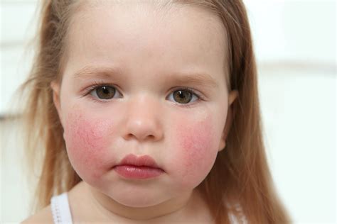 Fifth Disease Face